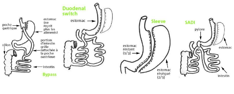 SADI, l’opération de la deuxième chance contre l'obésité - Nice-Matin