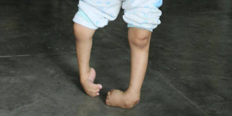 Causes, prise en charge, traitements... Que faire en cas de pied bot ...