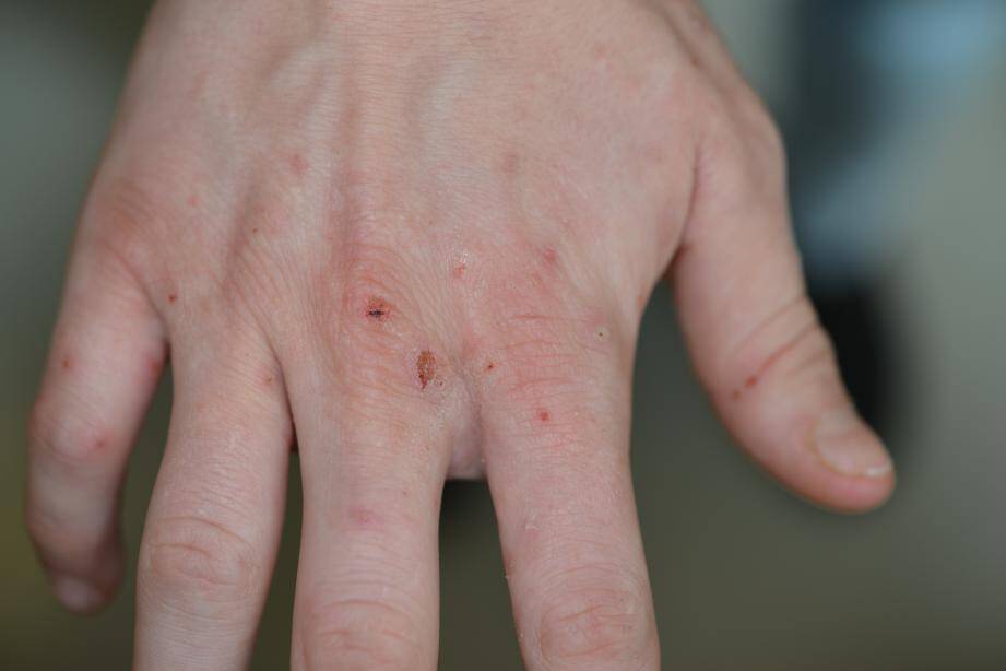 Vous avez attrapé la gale? Voici comment la traiter - Nice-Matin