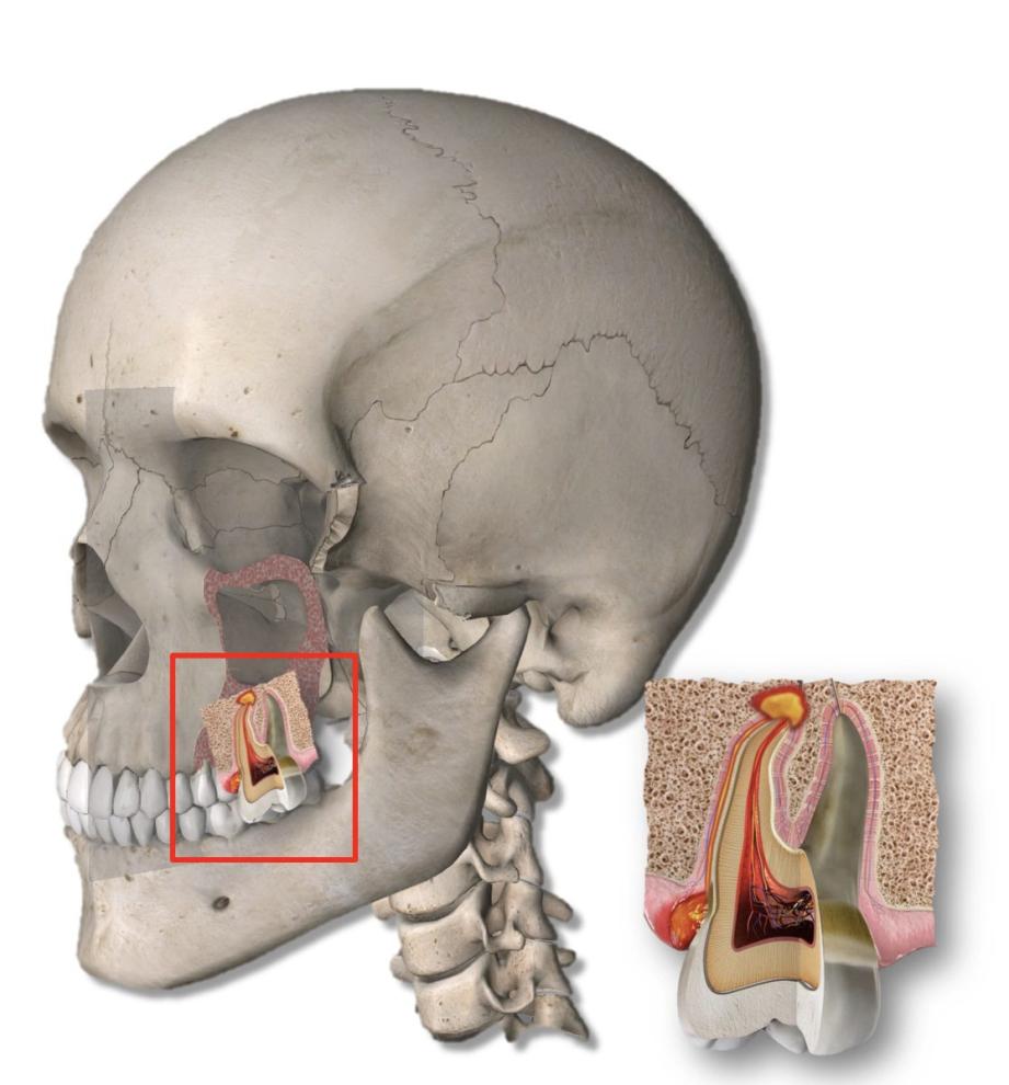 Et si votre sinusite chronique venait d'un problème aux dents? - Nice-Matin